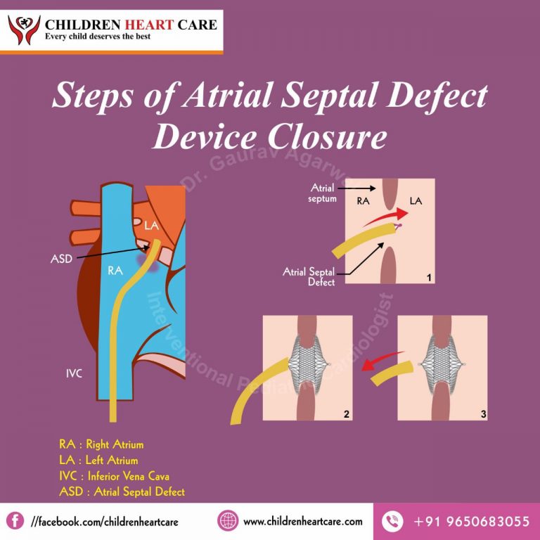 Best ASD Device Closure in Delhi - Dr. Gaurav Agrawal