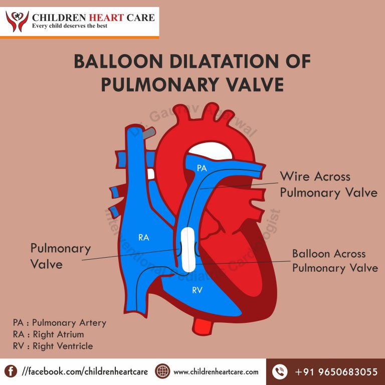Balloon Pulmonary Valvuloplasty - Dr. Gaurav Agrawal