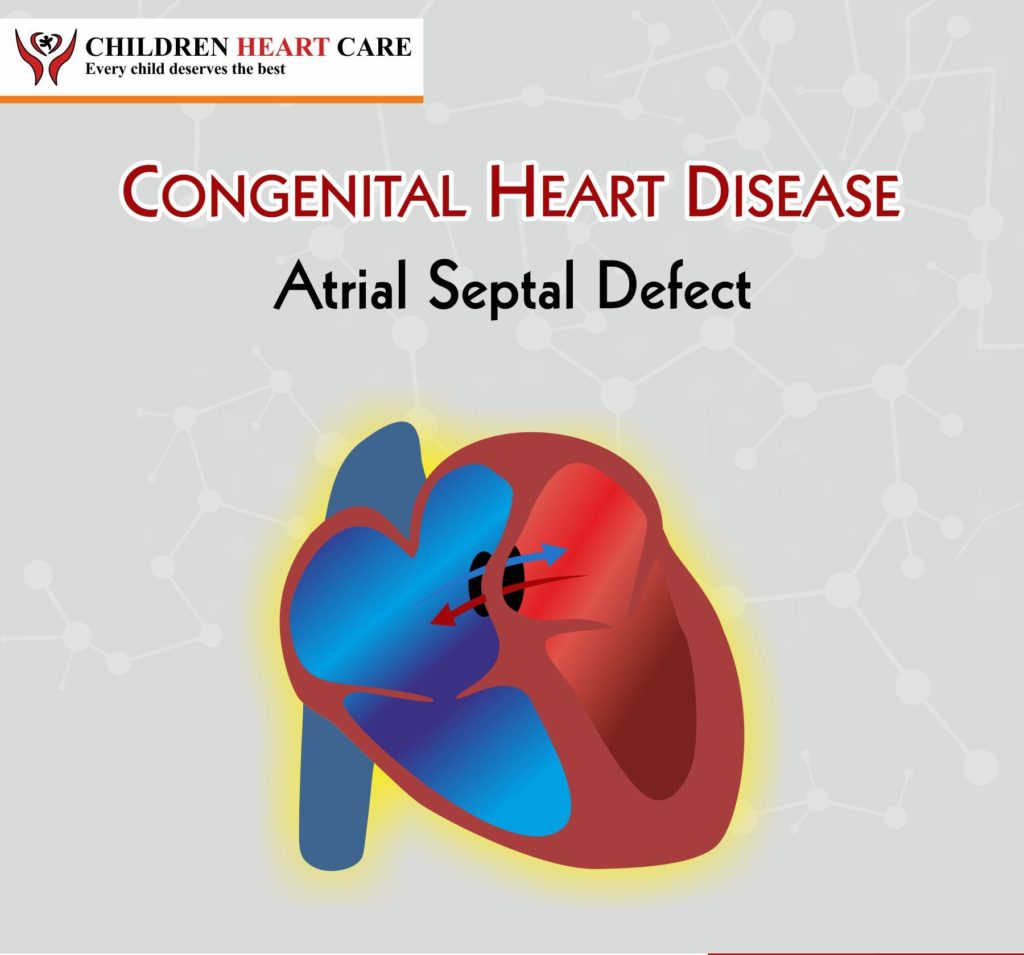 ATRIAL SEPTAL DEFECT (ASD) - Blog - Dr. Gaurav Agrawal