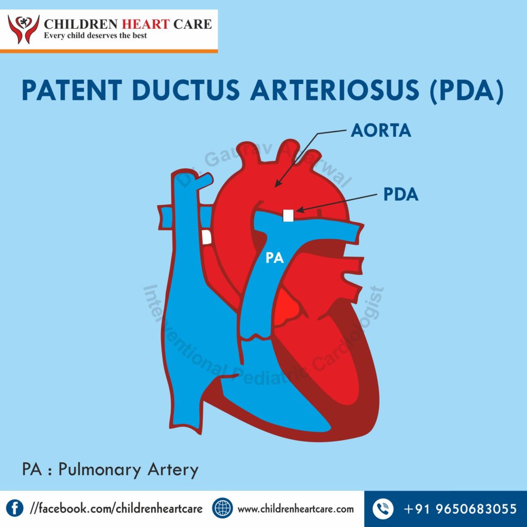PATENT DUCTUS ARTERIOSUS (PDA) IN CHILDREN - Dr. Gaurav Agrawal