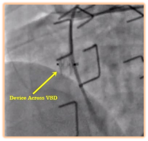 What is the treatment of VSD? - Dr. Gaurav Agrawal